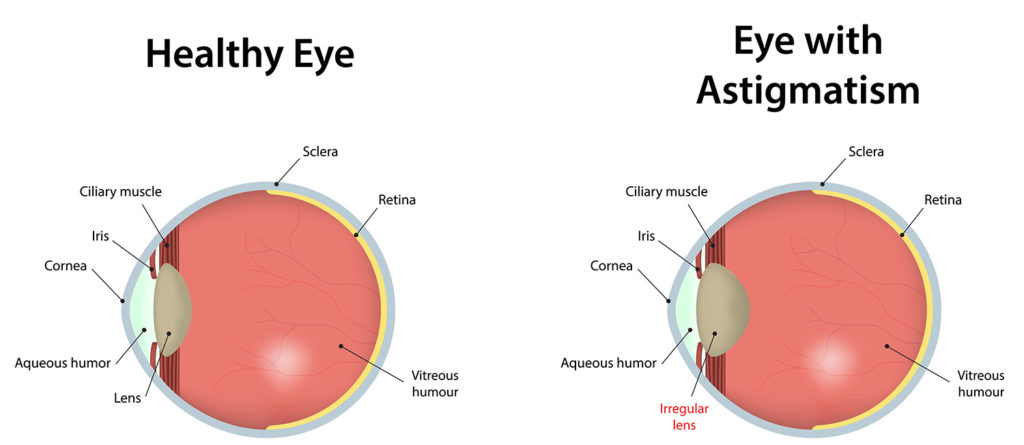 Astigmatism - Today's Vision River Oaks